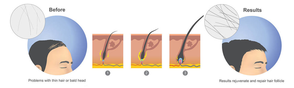 PDO Threads Offer - Imami Hair Restoration