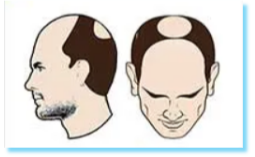 Understand Your Hair Loss - Imami Hair Restoration